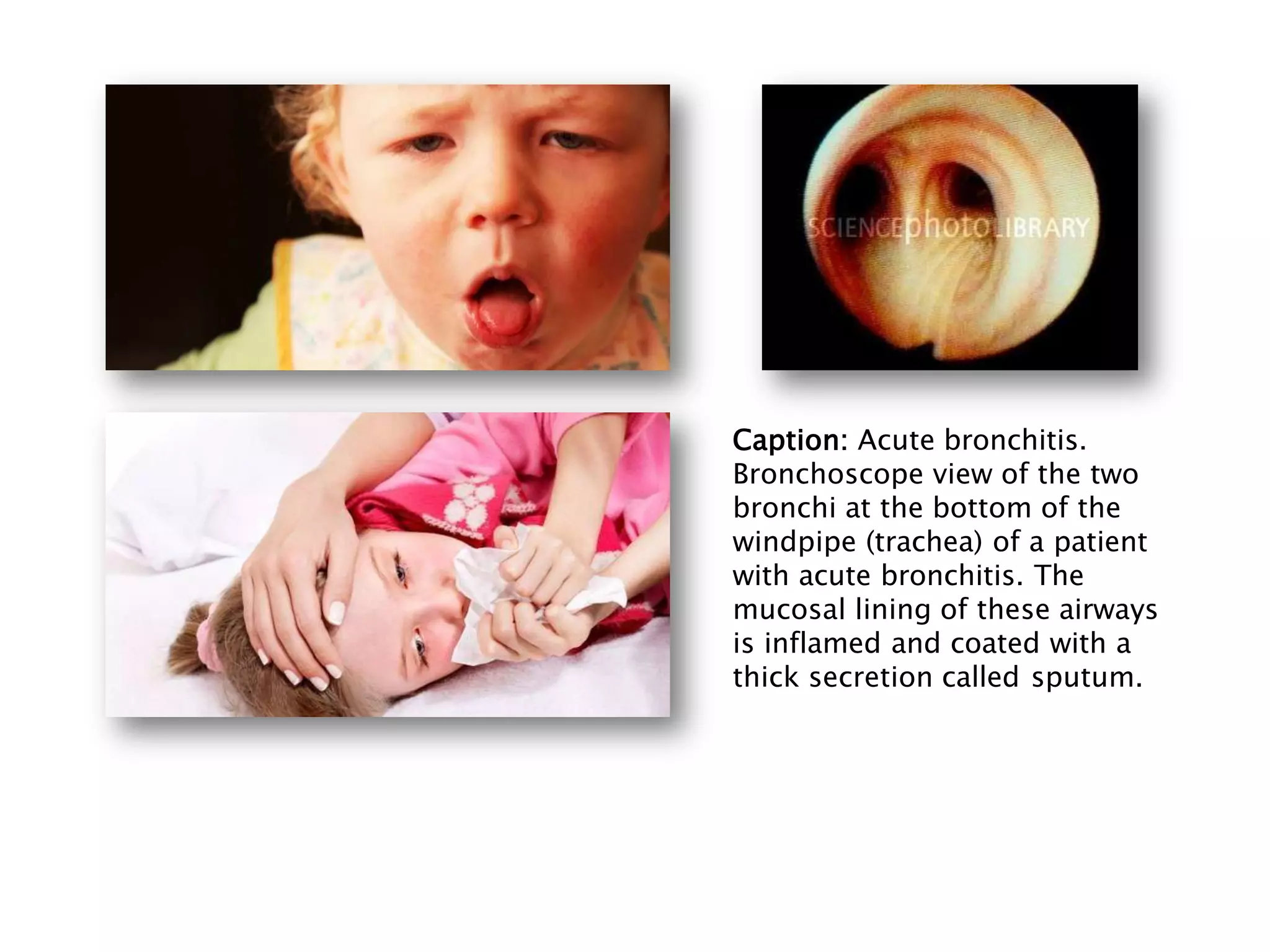 Bronchiolitis and bronchitis in children | PPTX