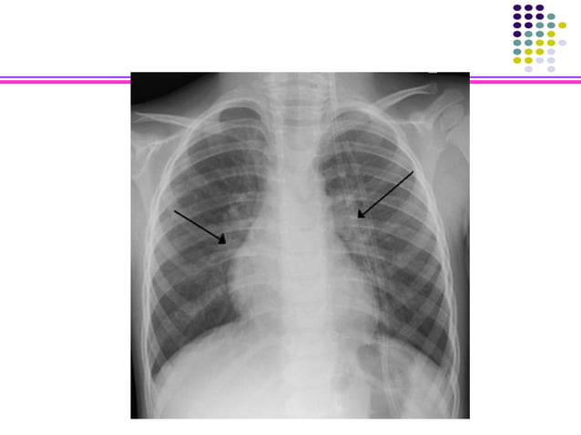Bronchiolitis, croup | PPT | Lung and Respiratory Health | Diseases and ...