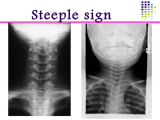Thumb Sign Vs Steeple Sign