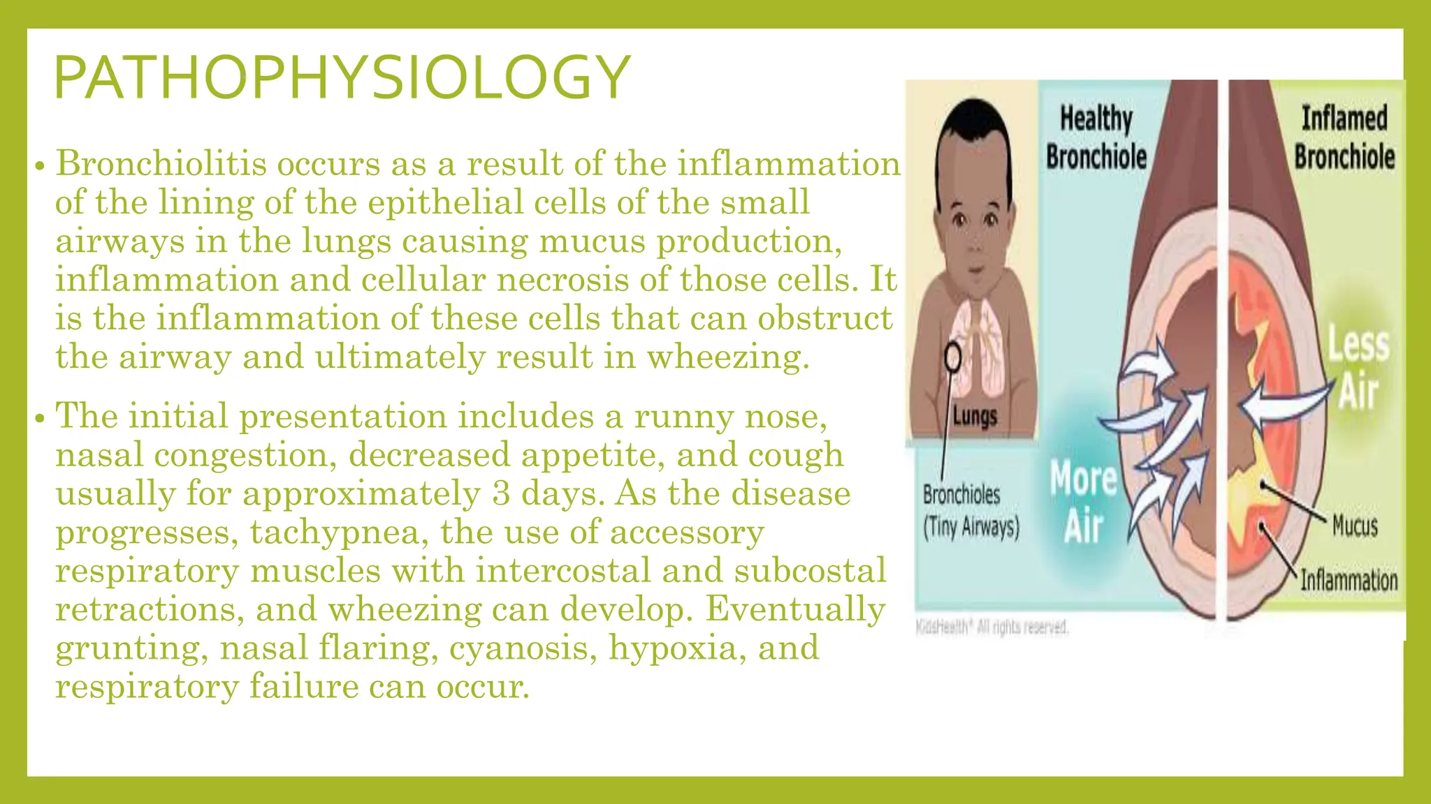 BRONCHIOLITIS & PNEUMONIA, pediatrics and adult | PPT