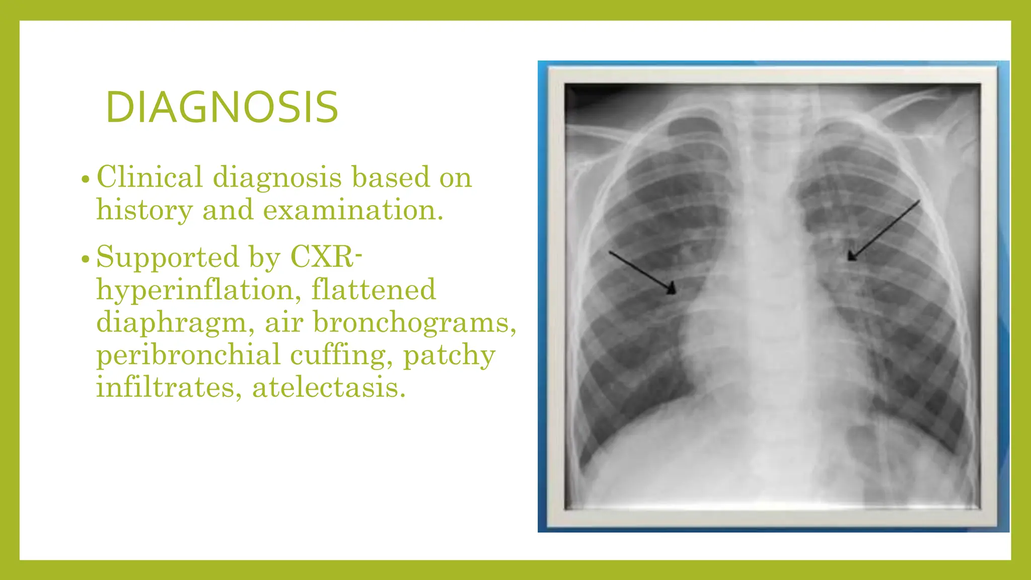 BRONCHIOLITIS & PNEUMONIA, pediatrics and adult | PPTX