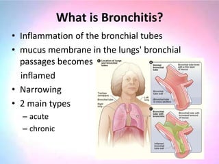 Bronchitis Disease | PPT