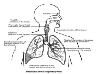 Bronchitis - Dhaval Joshi | PPTX