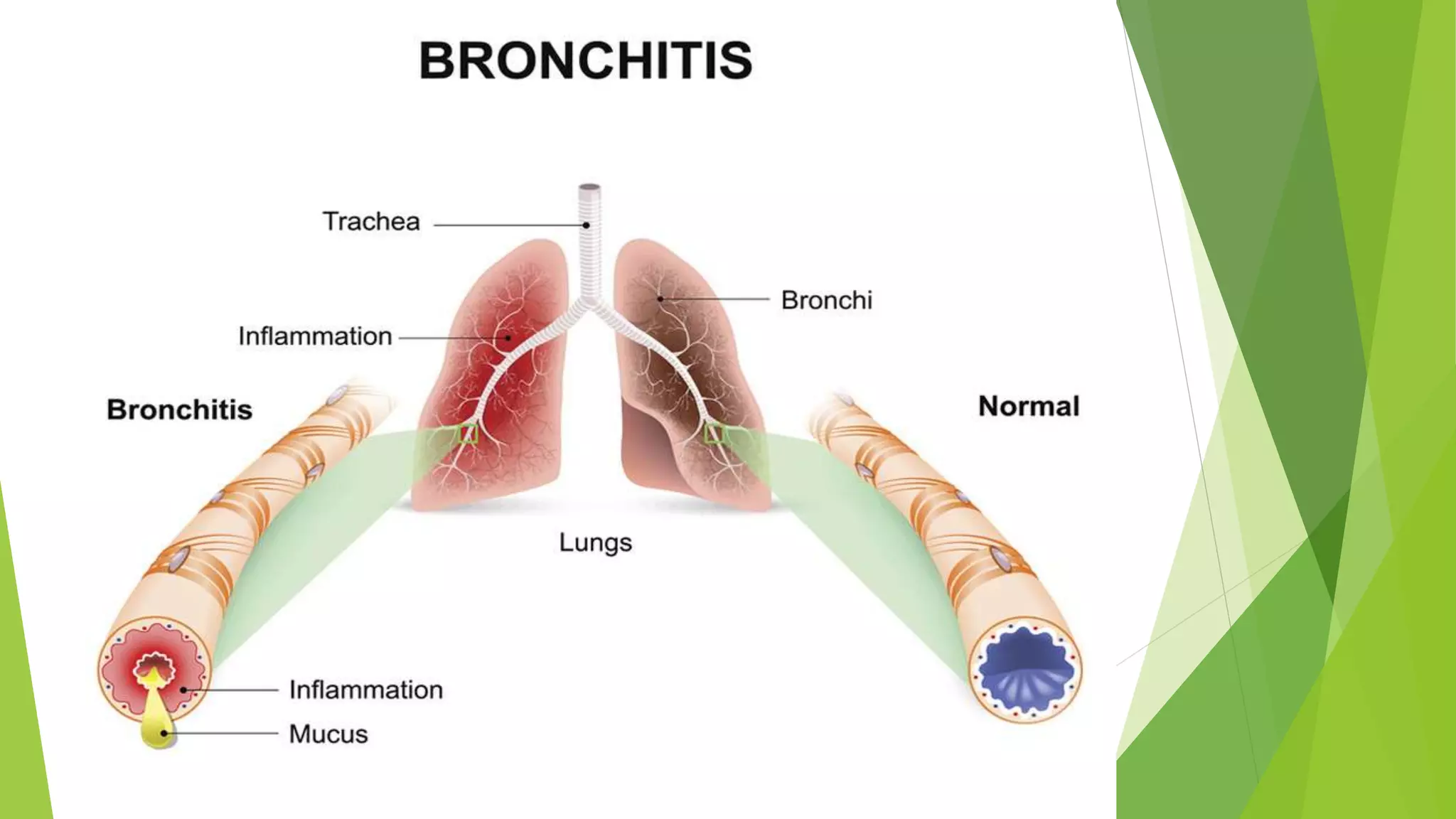 Bronchitis | PPTX