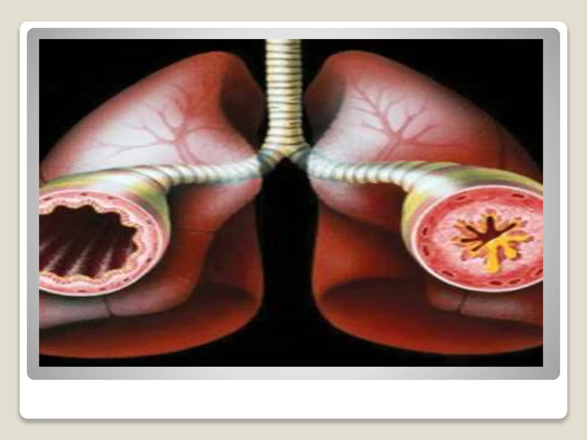 bronchitis Bronchitis is a condition that develops when the airways in ...