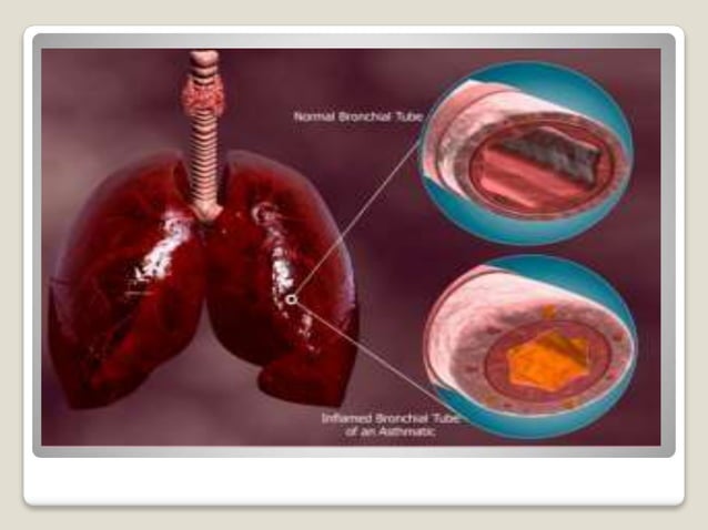 lower respiratory infections (bronchitis) | PPT
