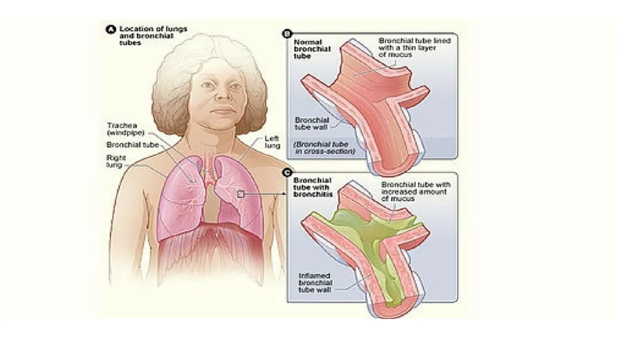 BRONCHITIS second bsc nursing msn-I topic | PPTX