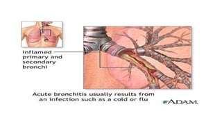 BRONCHITIS second bsc nursing msn-I topic | PPTX
