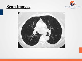 bronchitis case in radiology.pptx