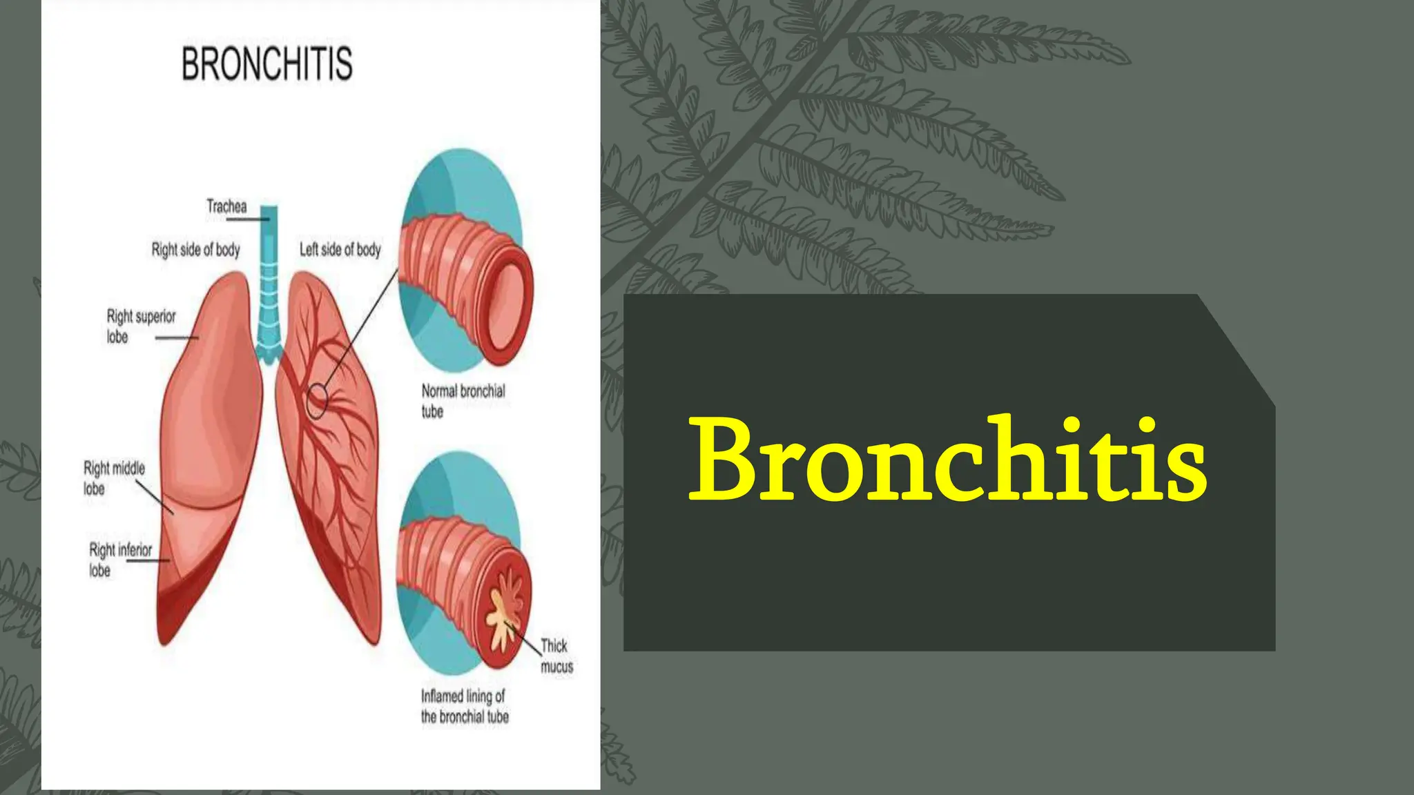 bronchitis, definition , etiology, clinics manifestations ...