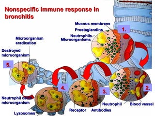 Bronchitis lecture in children | PPT