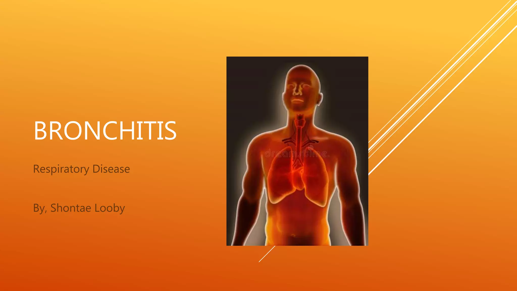 Bronchitis powerpoint | PPTX