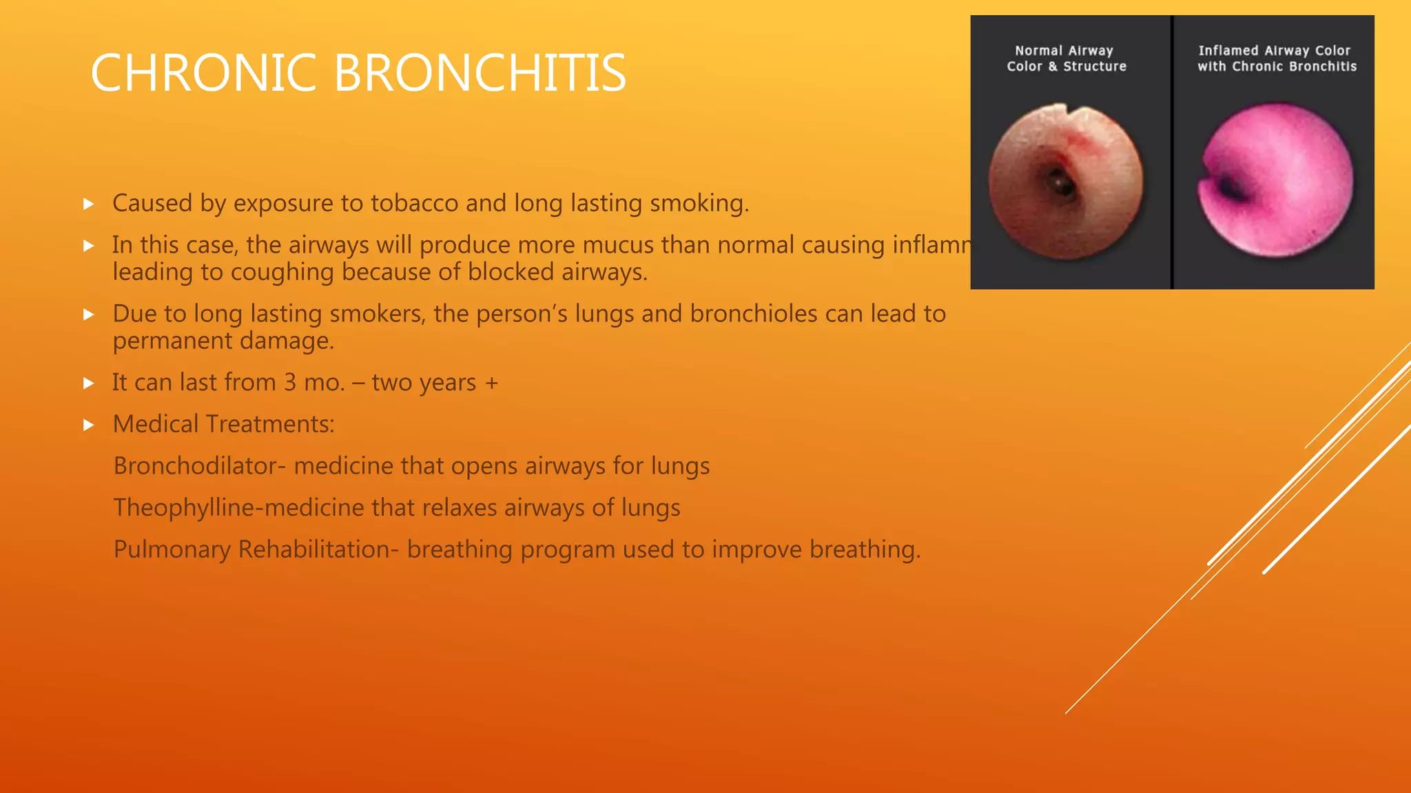 Bronchitis powerpoint | PPTX