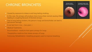 Bronchitis powerpoint | PPTX