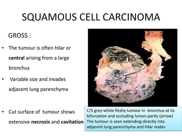 Bronchogenic Carcinoma | PPT