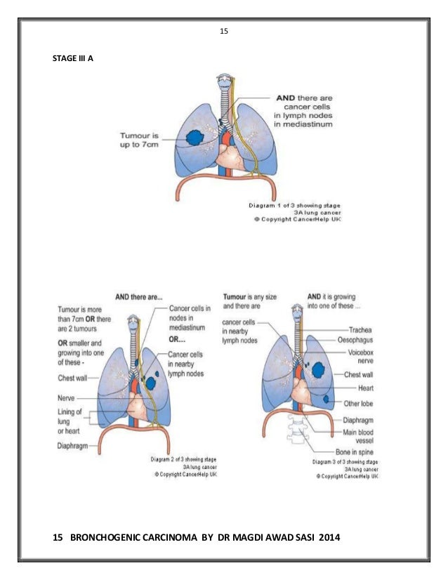 Bronchogenic carcinoma DR MAGDI SASI