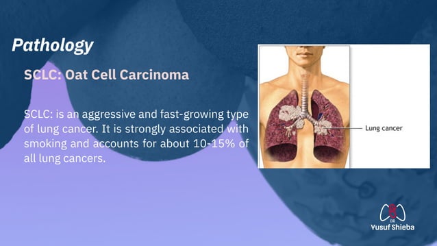 Bronchogenic carcinoma: Pathology, types, diagnosis and treatment | PDF