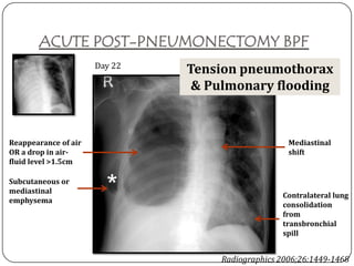 Bronchopleural fistula | PPT