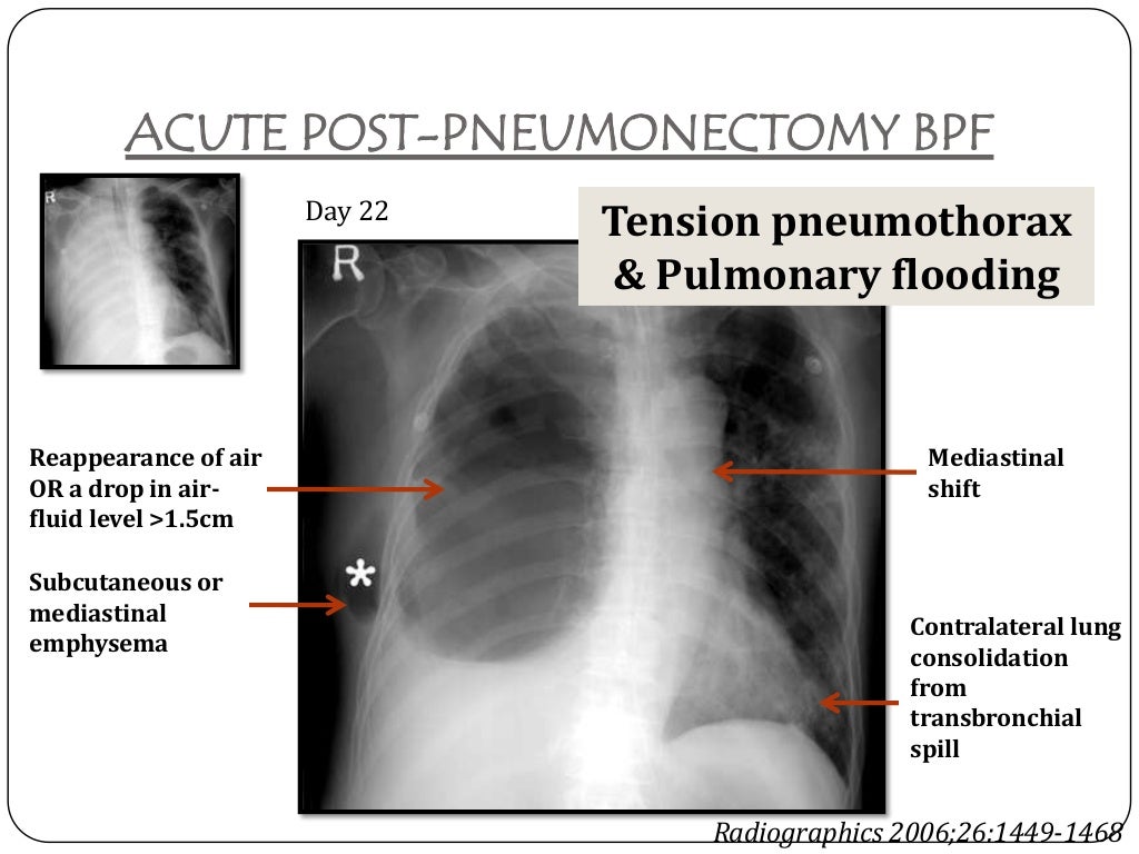 Bronchopleural fistula