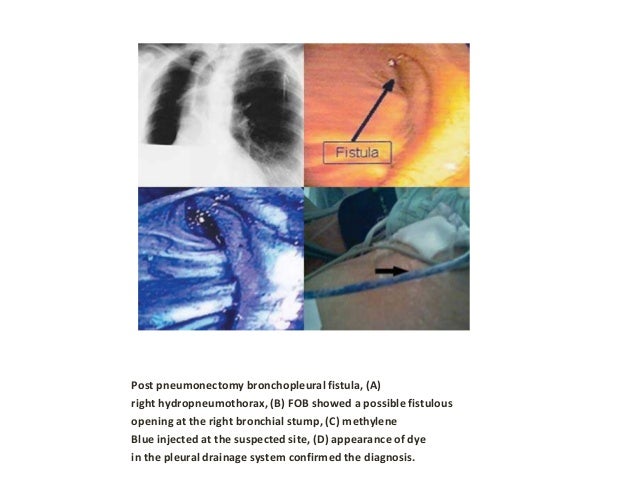 Bronchopleural fistula