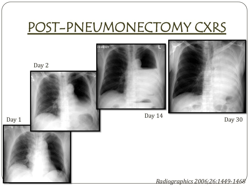 Bronchopleural fistula