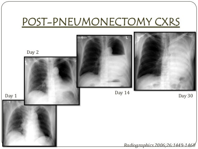 Bronchopleural fistula