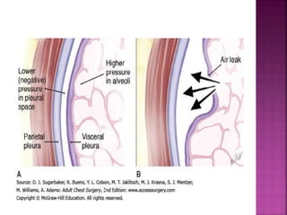 Bronchopleural fistula anesthetic concerns | PPT