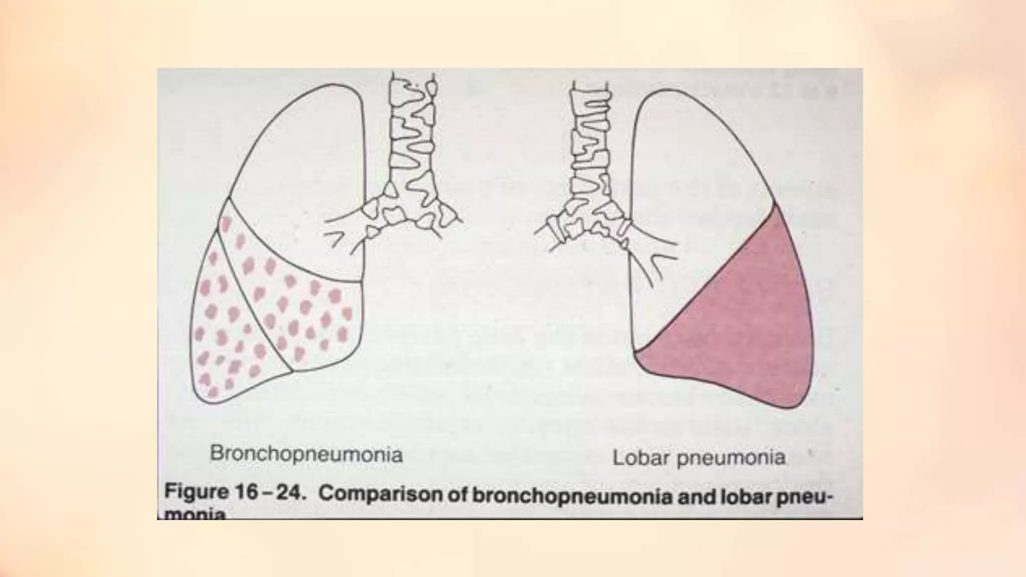 Bronchopneumonia (1) | PPTX