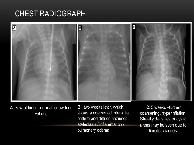 Bronchopulmonary dysplasia
