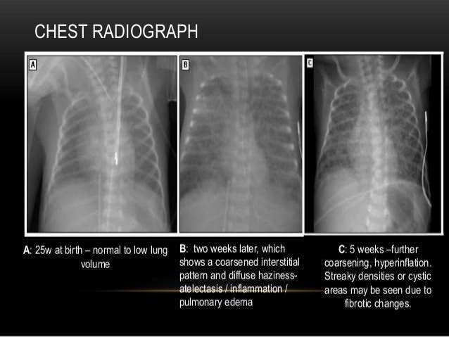 Bronchopulmonary dysplasia