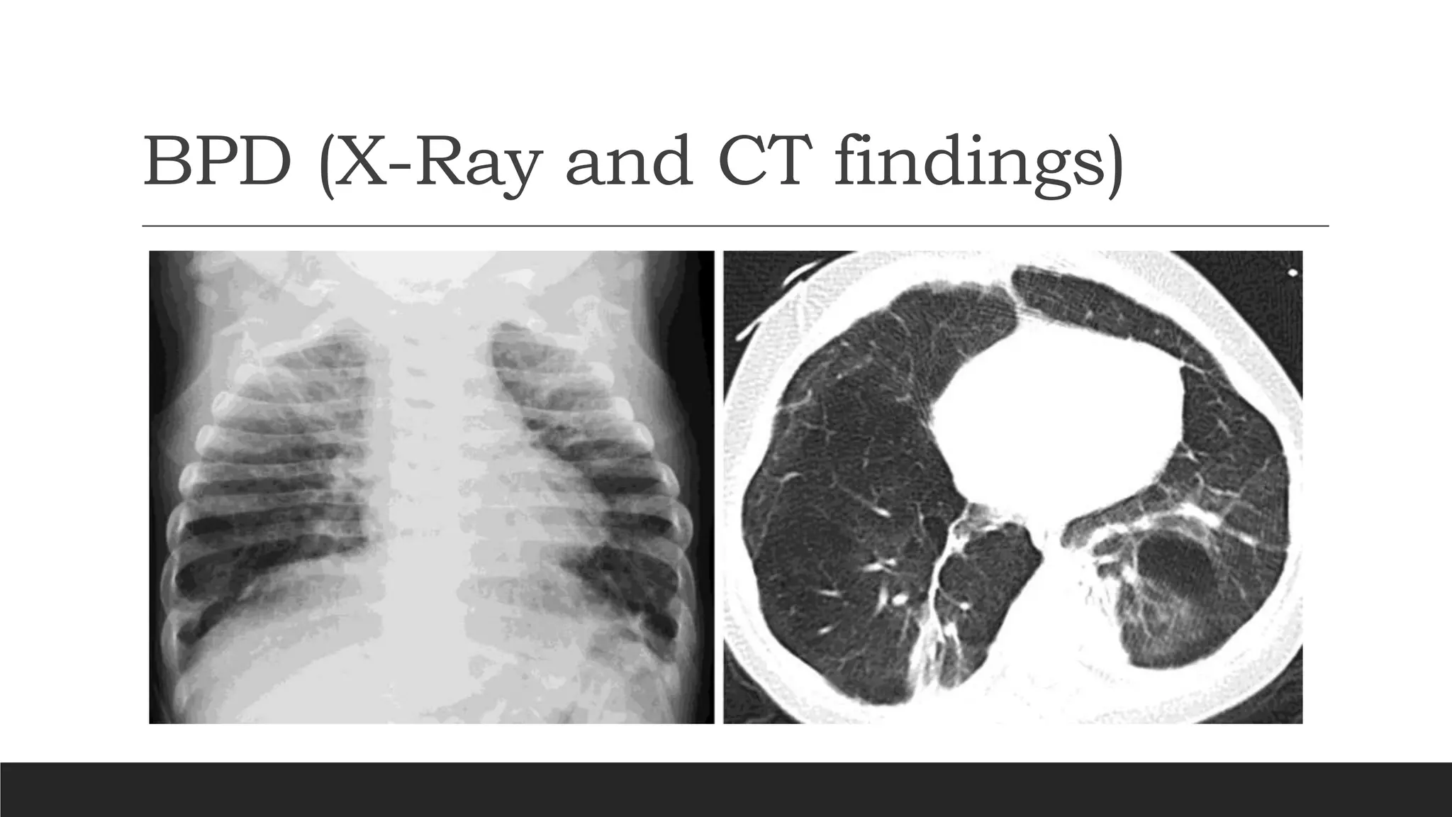 Broncho pulmonary dysplasia(BPD).pptx