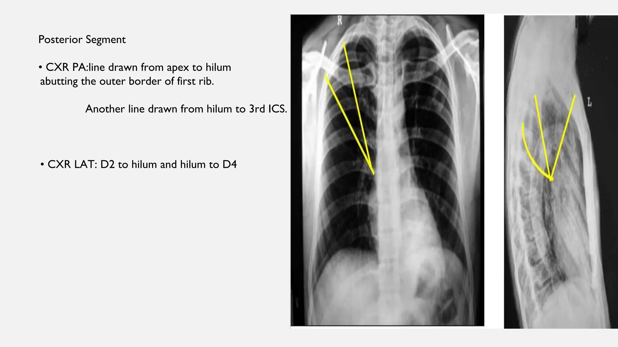 BRONCHOPULMONARY SEGMENTS RADIOLOGY AND IMAGING | PPTX
