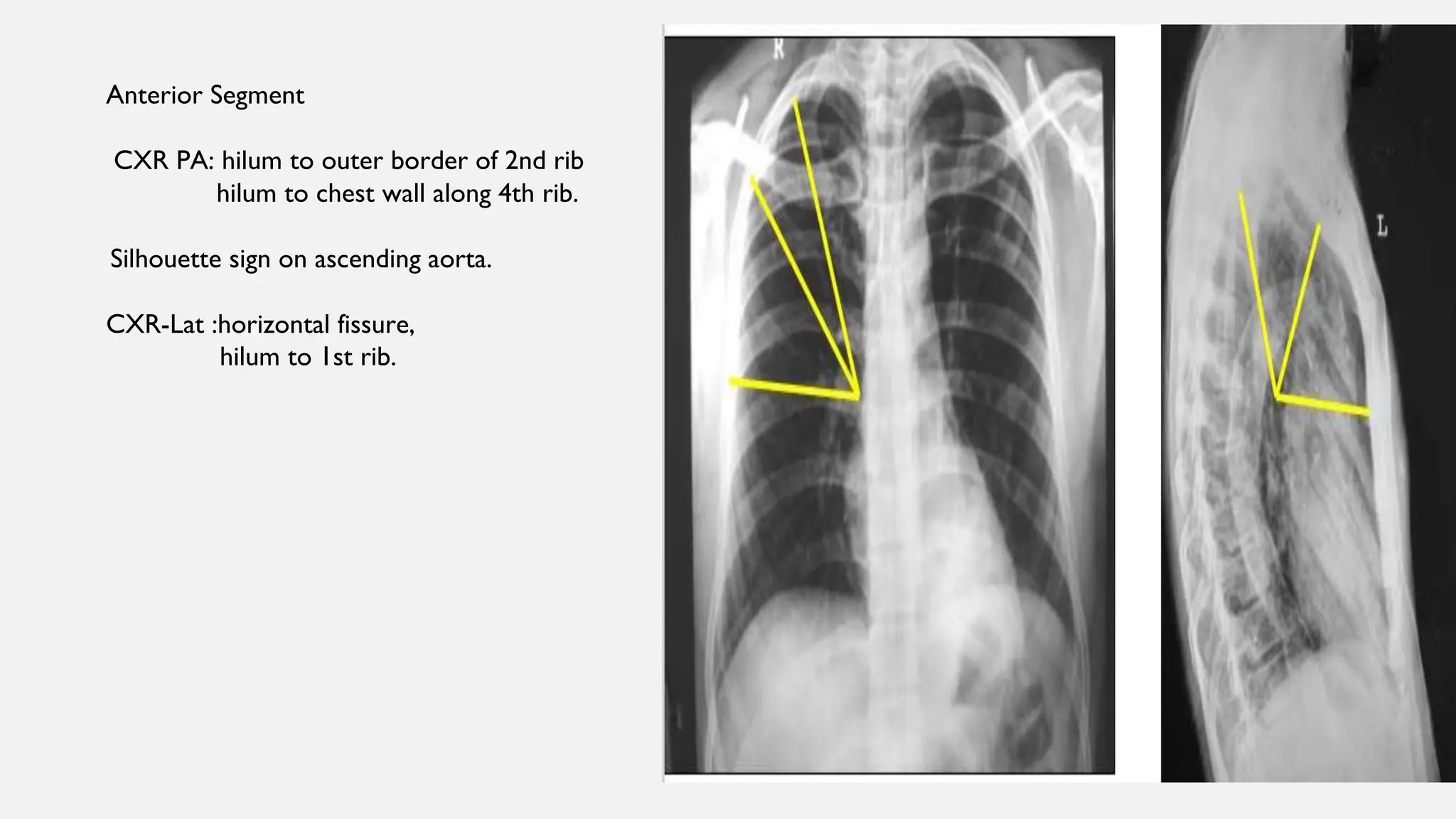 BRONCHOPULMONARY SEGMENTS RADIOLOGY AND IMAGING | PPTX