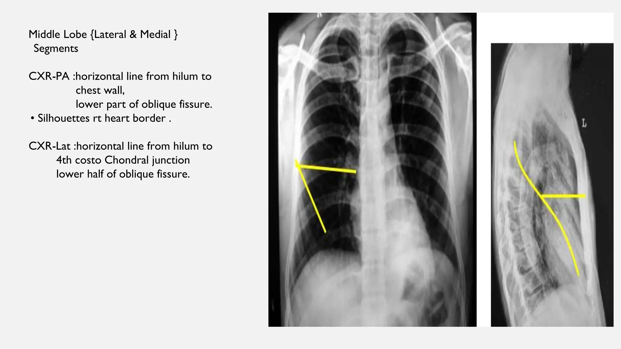 BRONCHOPULMONARY SEGMENTS RADIOLOGY AND IMAGING | PPTX