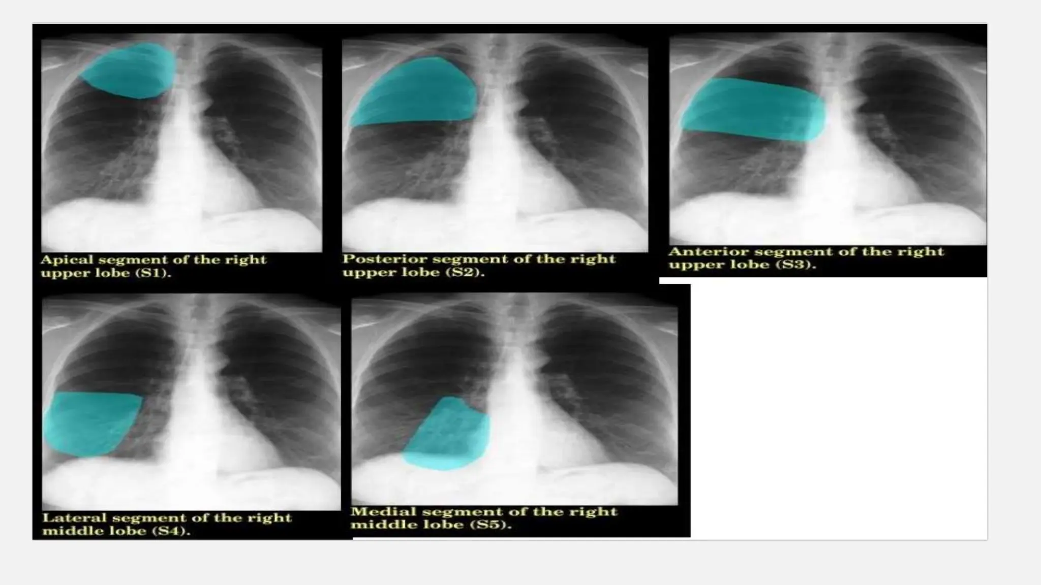 BRONCHOPULMONARY SEGMENTS RADIOLOGY AND IMAGING | PPTX