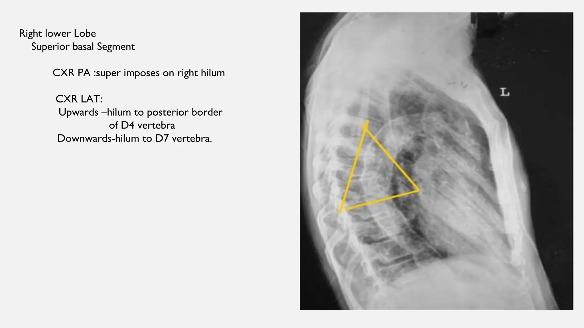BRONCHOPULMONARY SEGMENTS RADIOLOGY AND IMAGING | PPTX