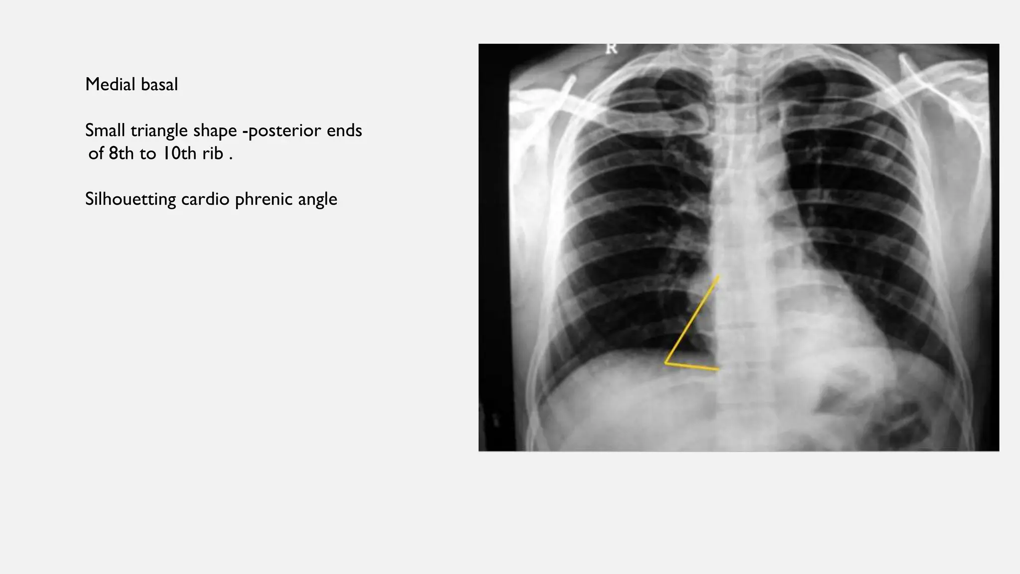 BRONCHOPULMONARY SEGMENTS RADIOLOGY AND IMAGING | PPTX
