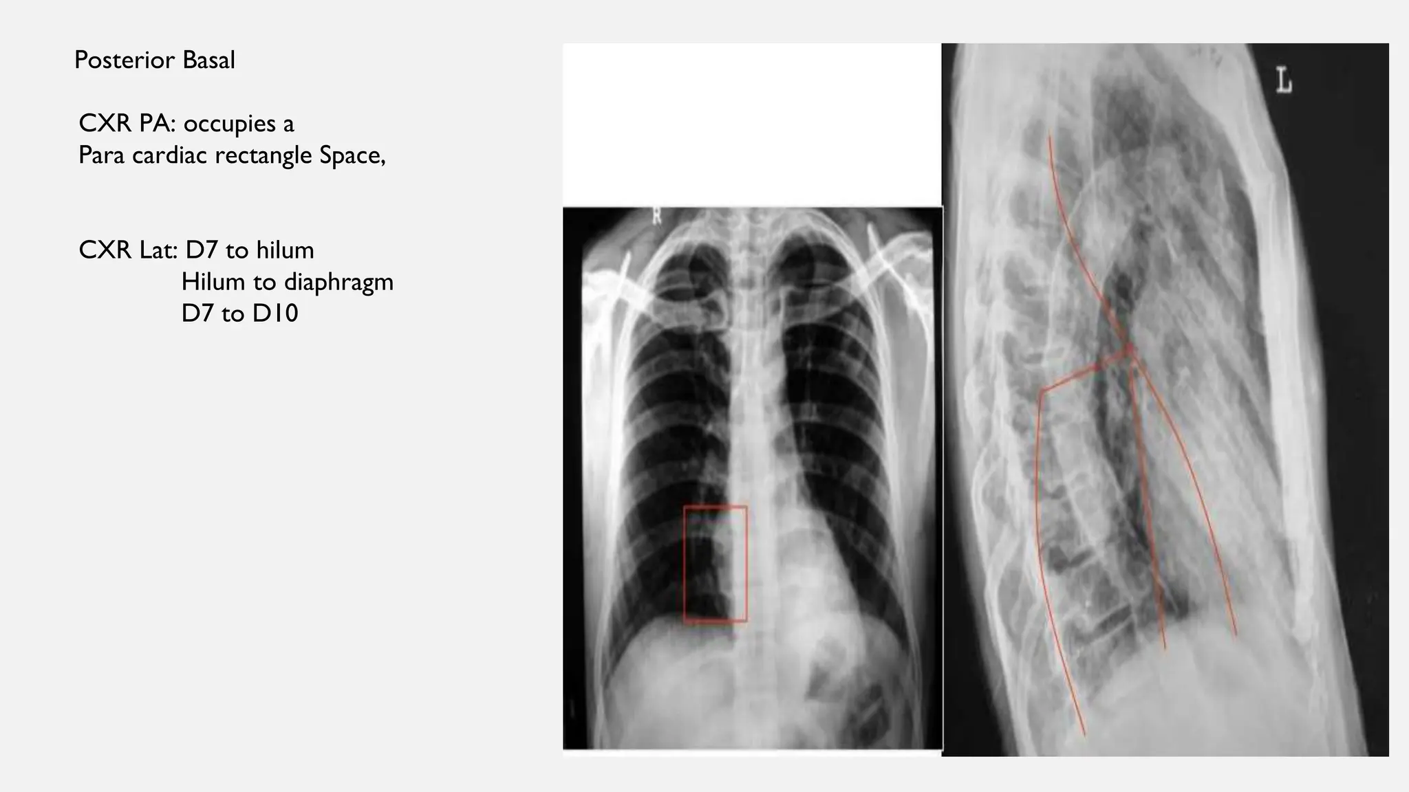 BRONCHOPULMONARY SEGMENTS RADIOLOGY AND IMAGING | PPTX