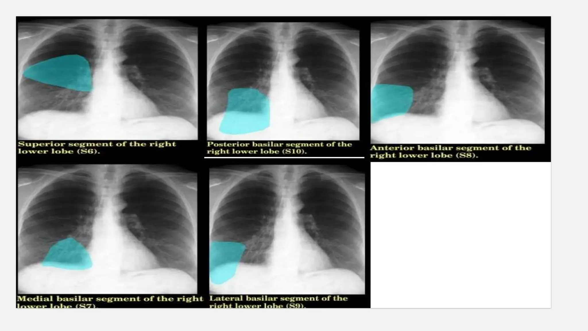 BRONCHOPULMONARY SEGMENTS RADIOLOGY AND IMAGING | PPTX