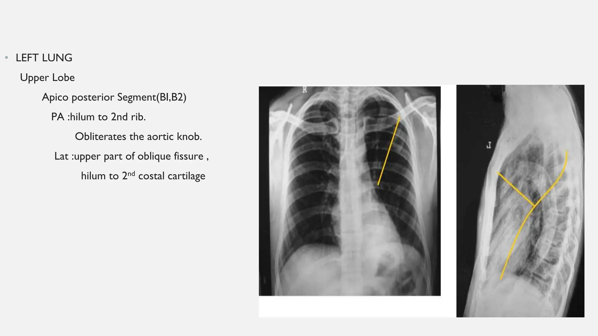 BRONCHOPULMONARY SEGMENTS RADIOLOGY AND IMAGING | PPTX