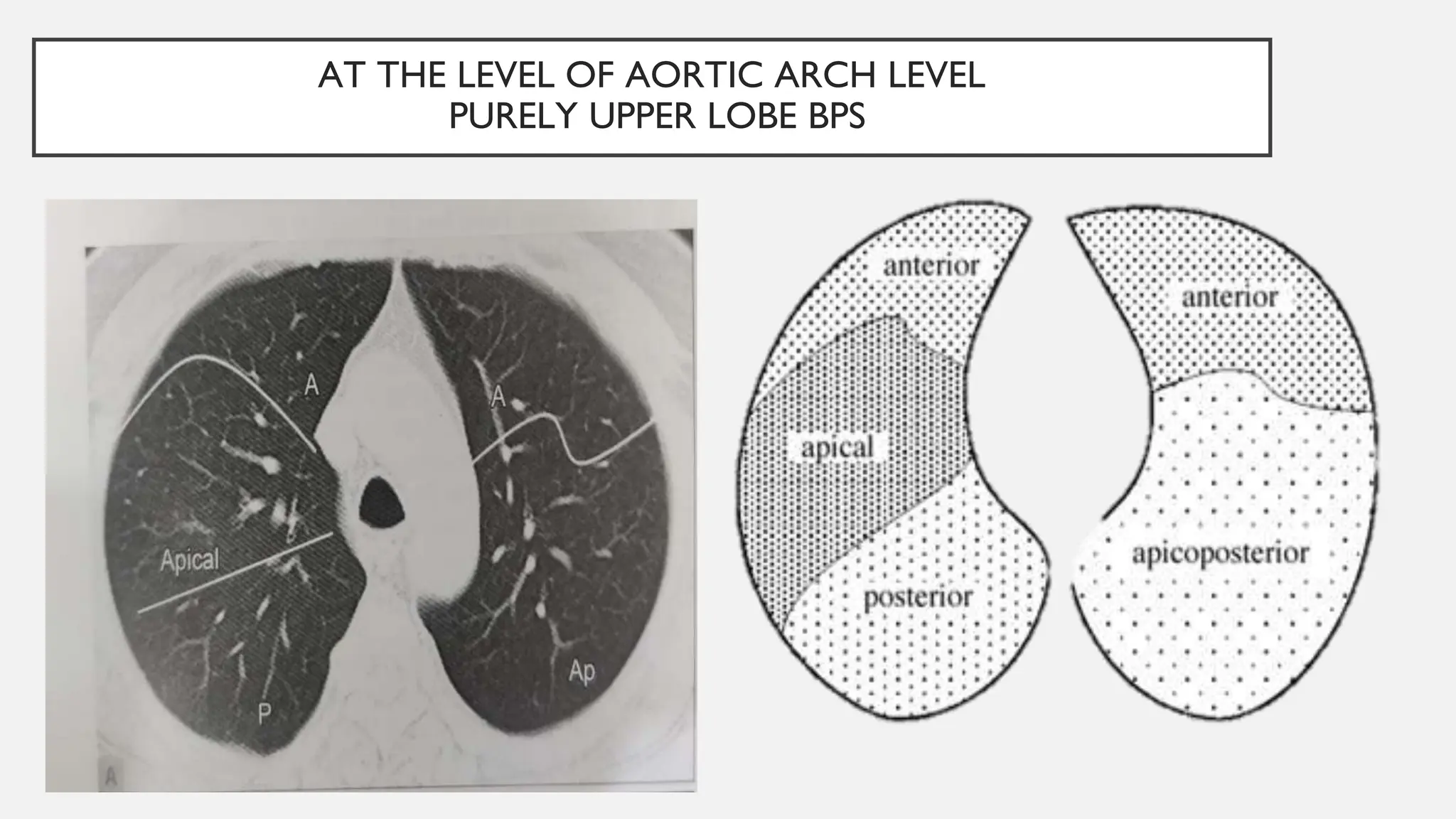 BRONCHOPULMONARY SEGMENTS RADIOLOGY AND IMAGING | PPTX