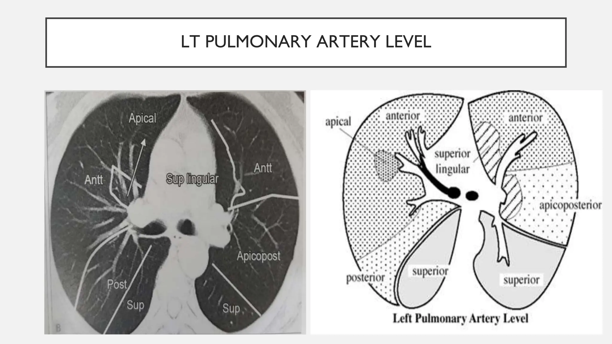 BRONCHOPULMONARY SEGMENTS RADIOLOGY AND IMAGING | PPTX