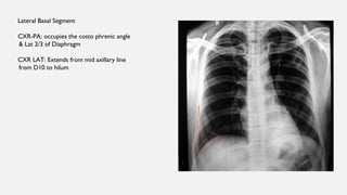 BRONCHOPULMONARY SEGMENTS RADIOLOGY AND IMAGING | PPTX