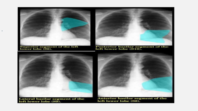 BRONCHOPULMONARY SEGMENTS RADIOLOGY AND IMAGING | PPTX