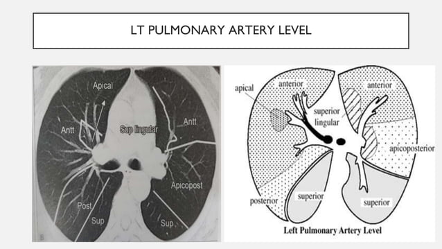 BRONCHOPULMONARY SEGMENTS RADIOLOGY AND IMAGING | PPTX