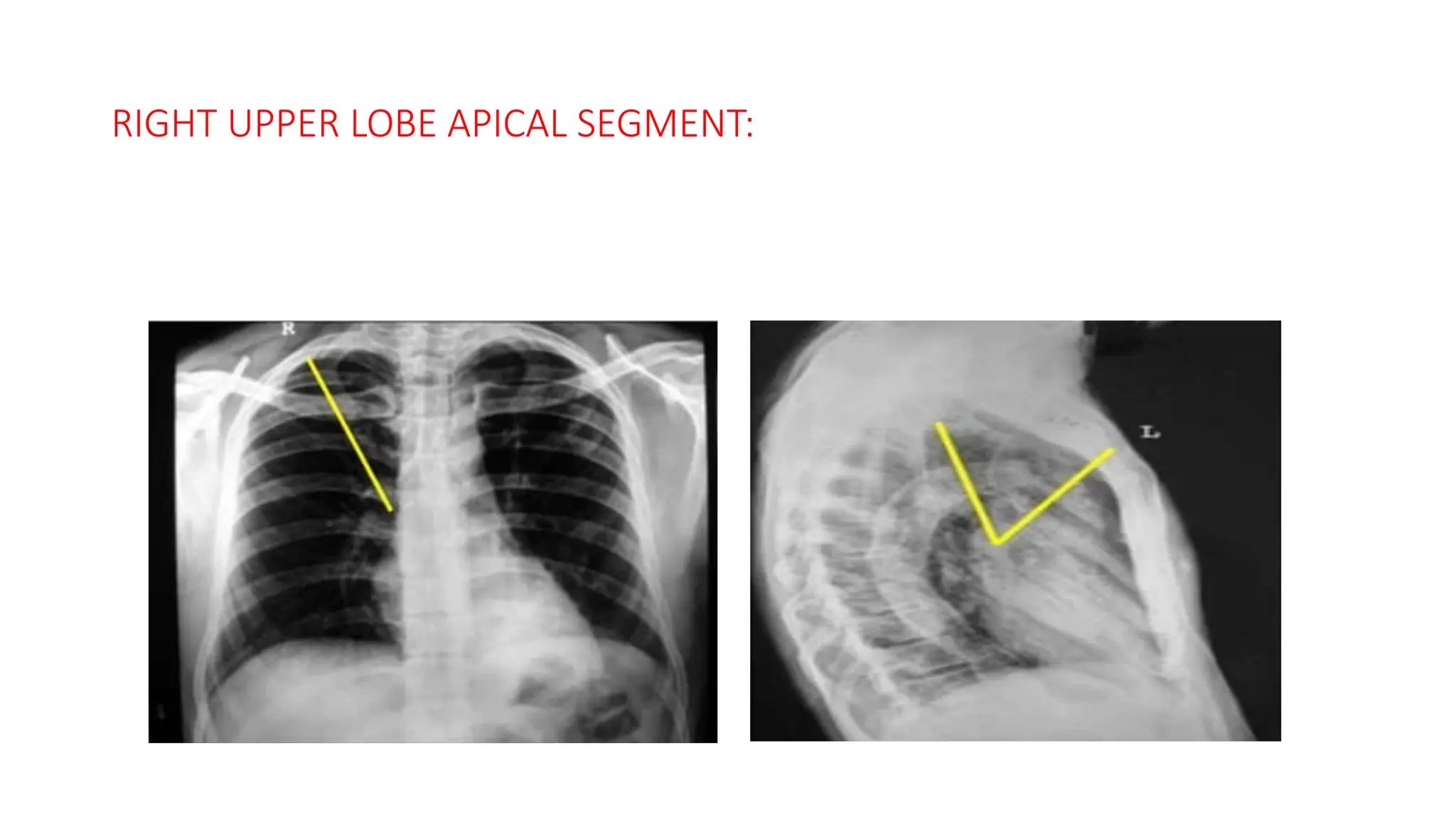 BRONCHO PULMONARY SEGMENTS of lung .pptx