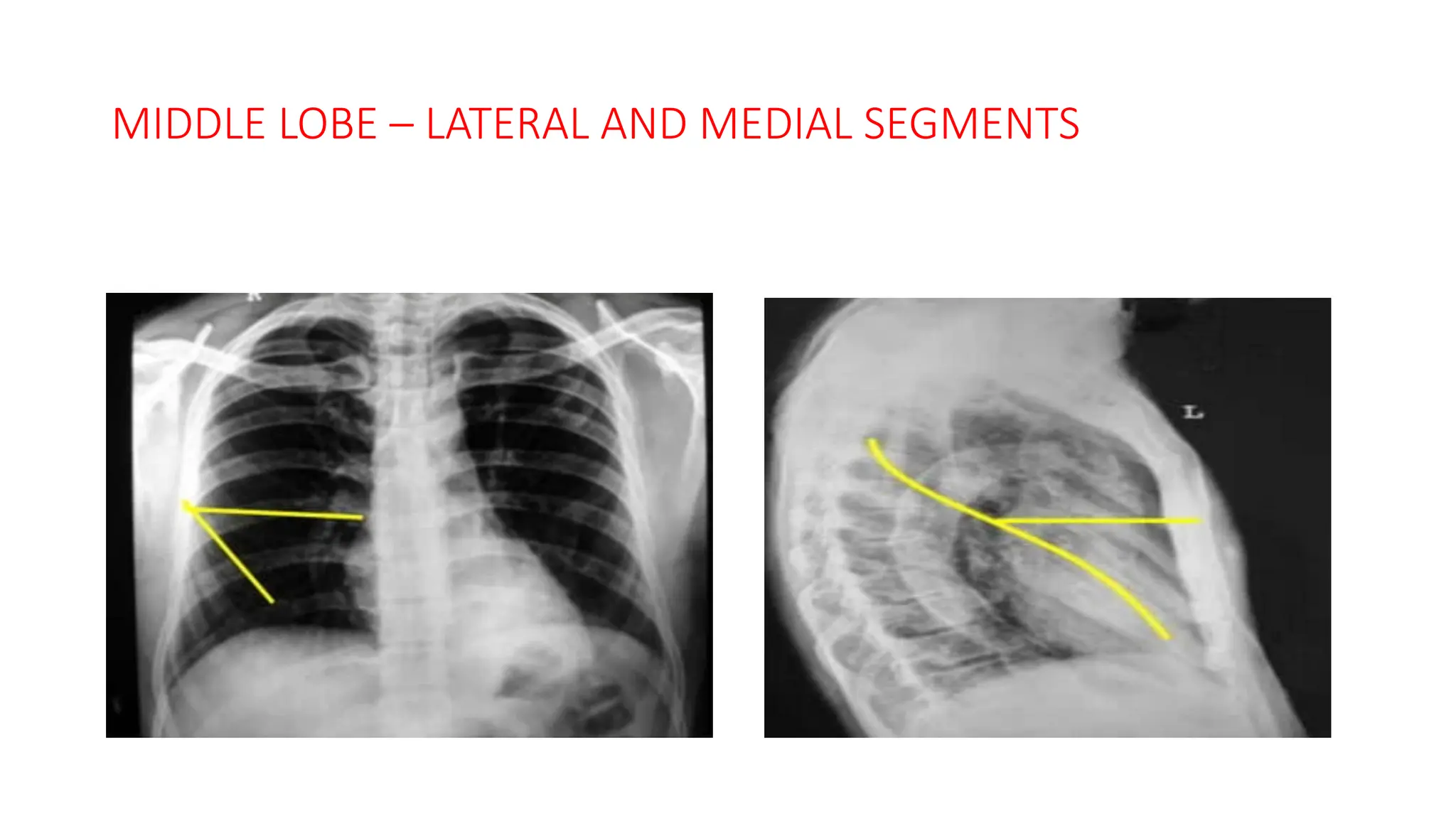 BRONCHO PULMONARY SEGMENTS of lung .pptx