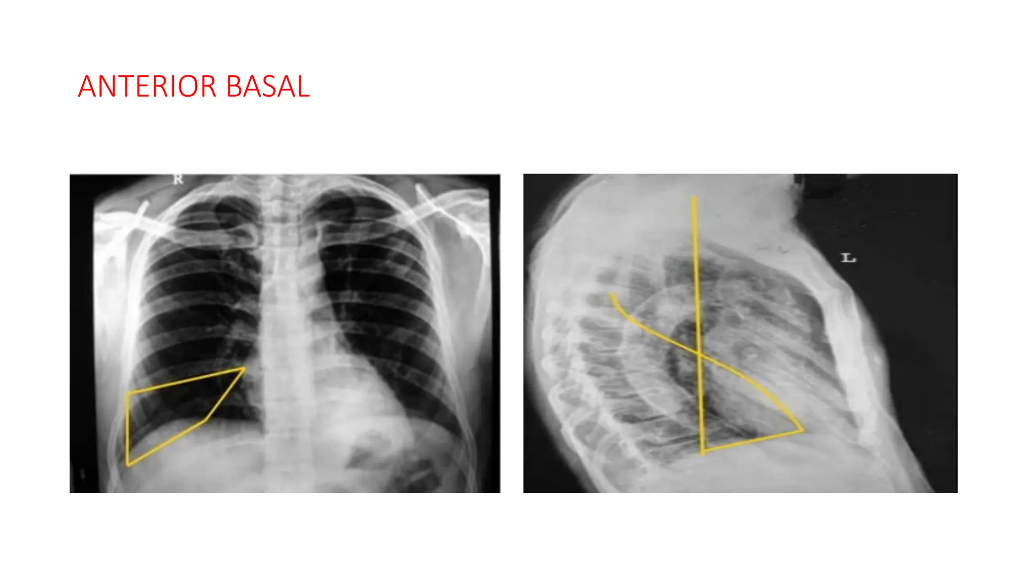 BRONCHO PULMONARY SEGMENTS of lung .pptx