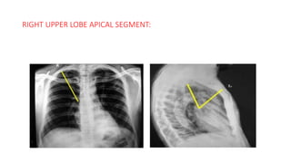 BRONCHO PULMONARY SEGMENTS of lung .pptx
