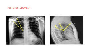 BRONCHO PULMONARY SEGMENTS of lung .pptx